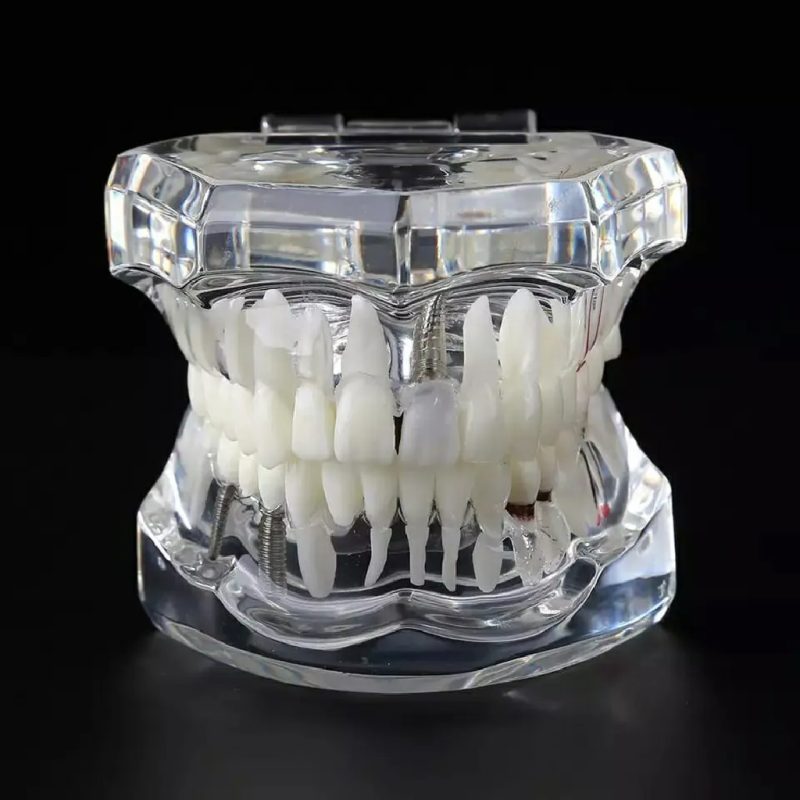Dental Implant Models M2001C - Wali Dental Supply