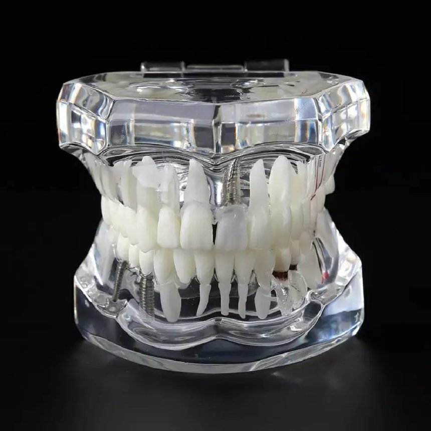 Dental Implant Models M2001C - Wali Dental Supply